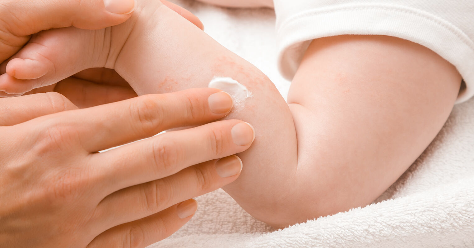 Baby Eczema Relief Hacks and Tricks to Know | Cetaphil US